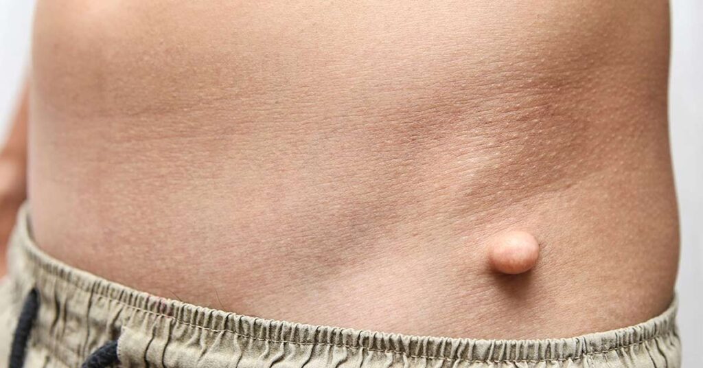 O que são tumores benignos de partes moles: lipoma e mais » Dr. André ...
